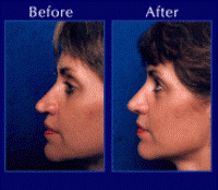 The Nose Clinic | Congenital tip deformations